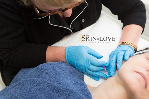 What is a Thread Lift? | Treatment Guide | Skin To Love Clinic