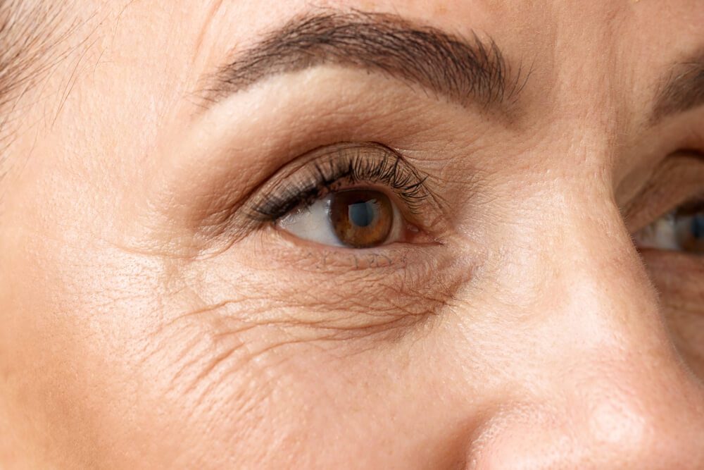 The Best Treatment for Under Eye Wrinkles: Your Comprehensive Guide | S2L