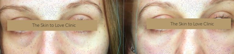 SuneKos Skin Rejuvenation Treatment | Skin To Love