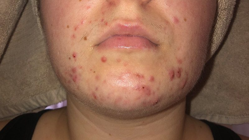 What Is The Best Treatment For Acne? | The Skin to Love Clinic