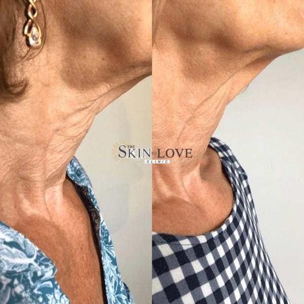 Profhilo Before And After Photos | The Skin To Love Clinic