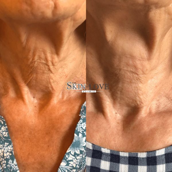 Profhilo Before And After Photos | The Skin To Love Clinic