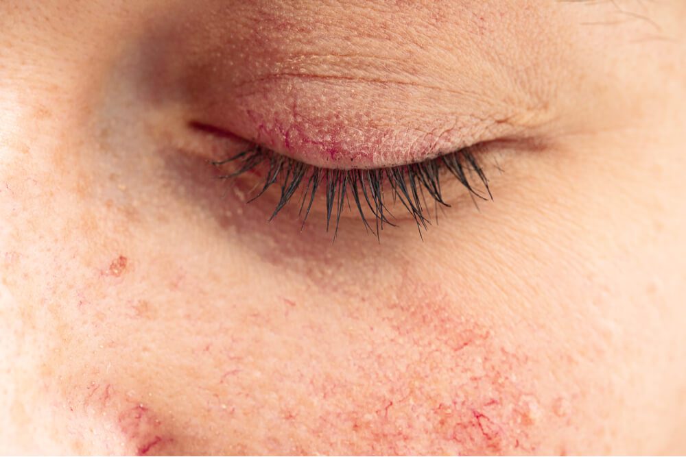 Which Rosacea Treatment Works? | Skin to Love Clinic