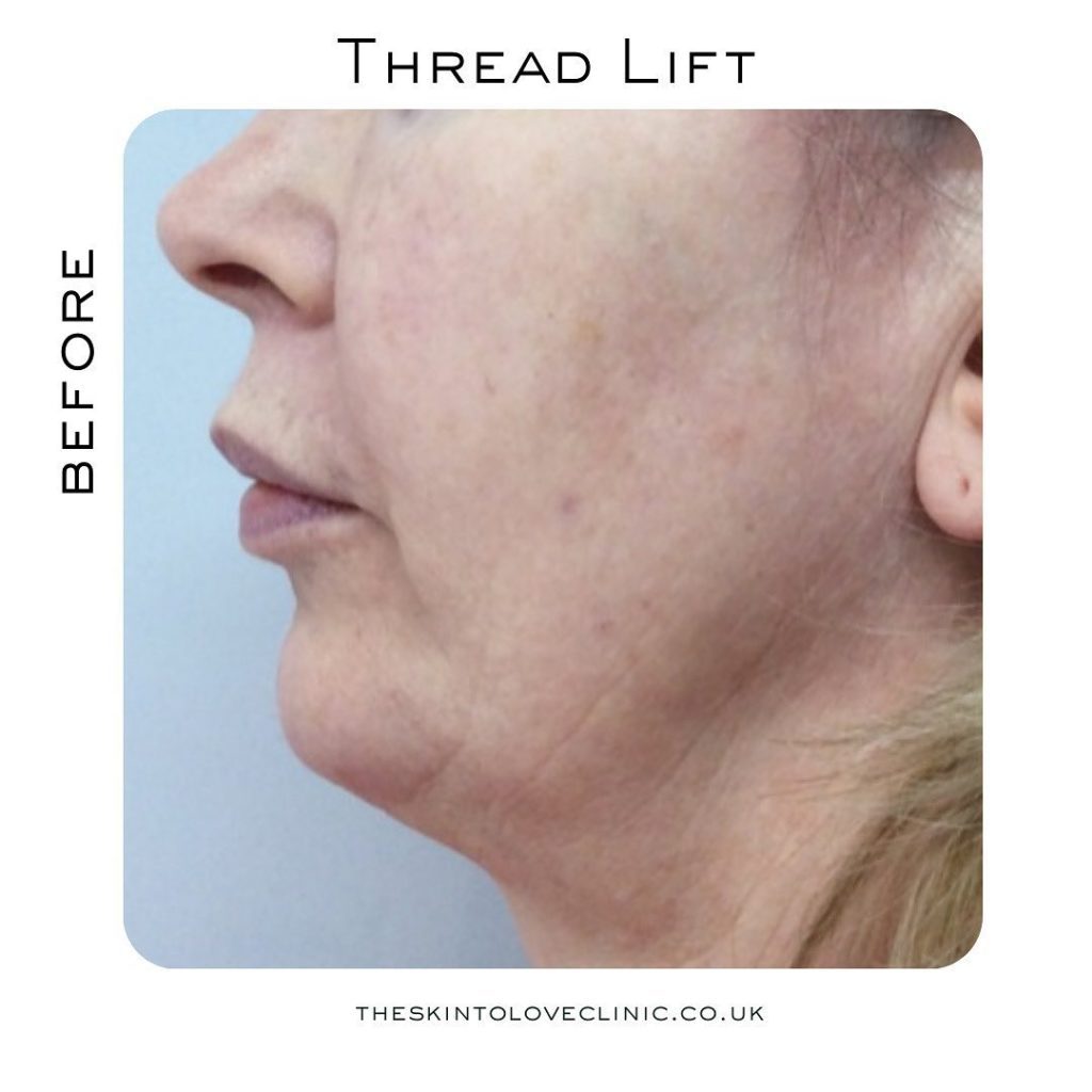 Is Thread Lift Worth it? | Thread Lift Before and After| S2L