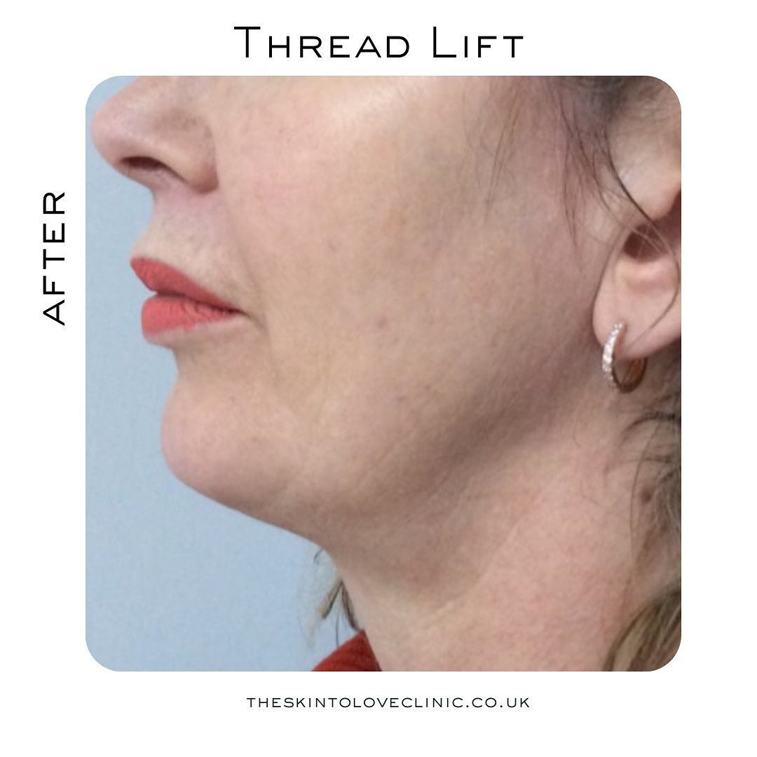 Is Thread Lift Worth It Thread Lift Before And After S2L Is Thread Lift Worth It Thread Lift Before And After S2L