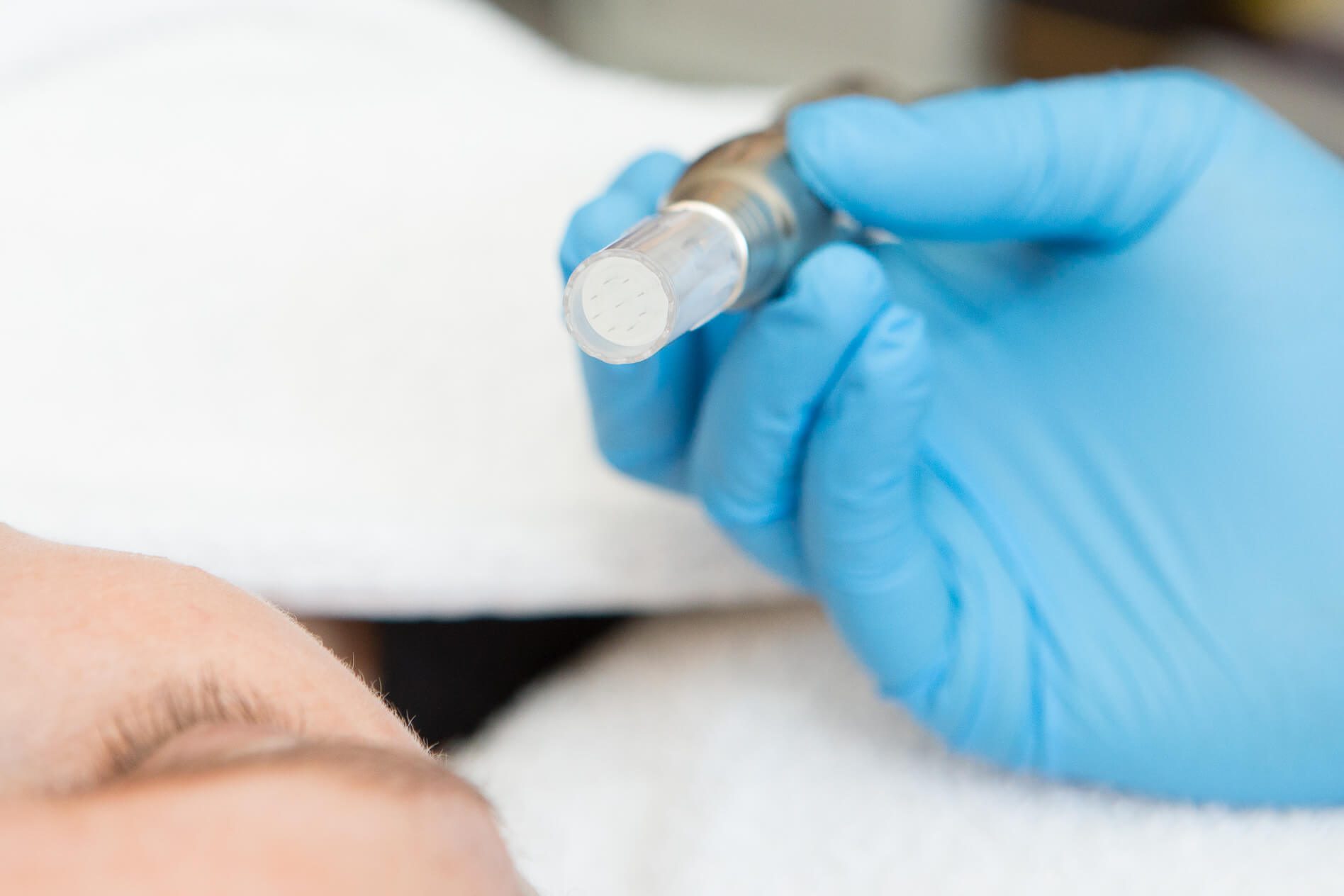9 Treatments For Acne Scarring | Will Acne Scarring Go Away? | S2L Clinic