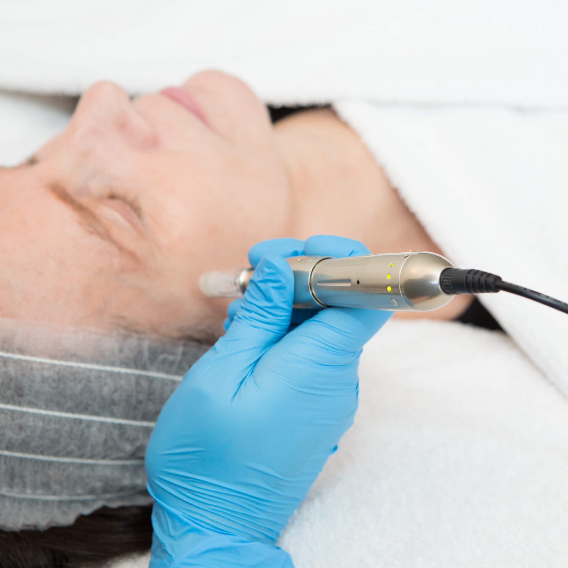 9 Treatments For Acne Scarring | Will Acne Scarring Go Away? | S2L Clinic