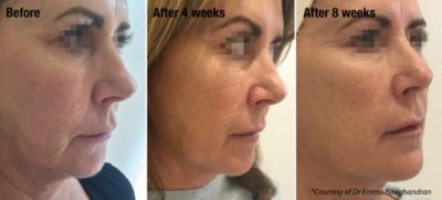 Profhilo Treatment | Before & After Photos | Skin To Love Clinic