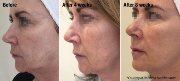 Profhilo Treatment | Before & After Photos | Skin To Love Clinic