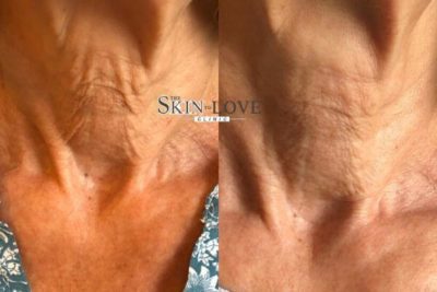 Profhilo Treatment | Before & After Photos | Skin To Love Clinic