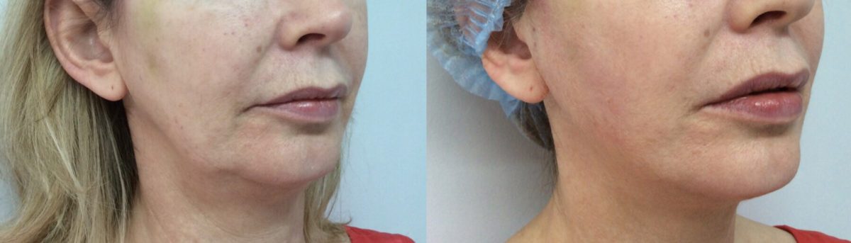 7 Questions About Threat Lift Treatment | Skin To Love Clinic