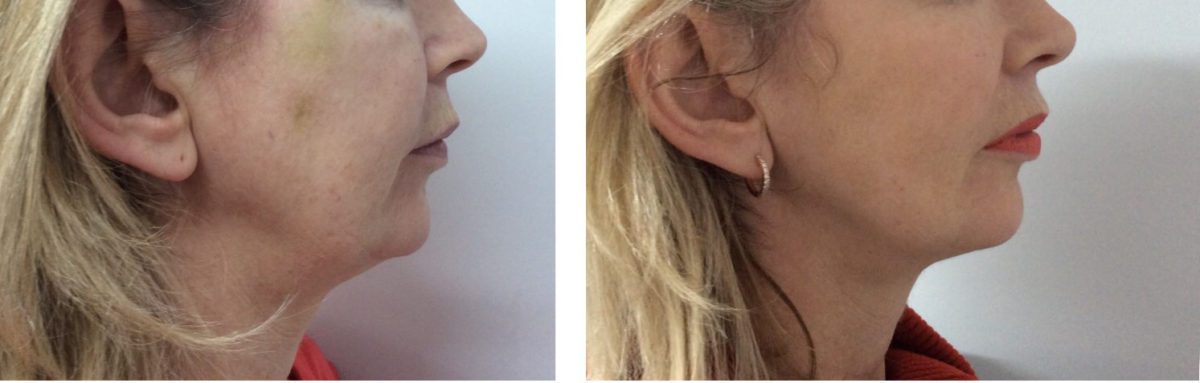 Facial Thread Lift Treatment | Loose Skin Treatment | Skin To Love