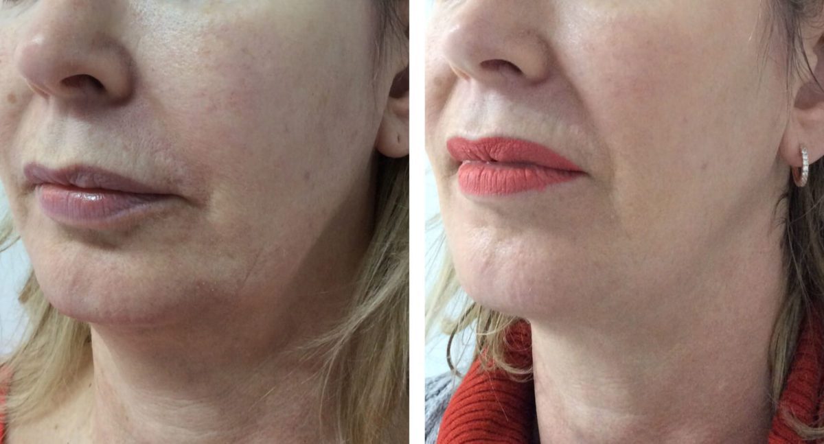 7 Questions About Threat Lift Treatment | Skin To Love Clinic