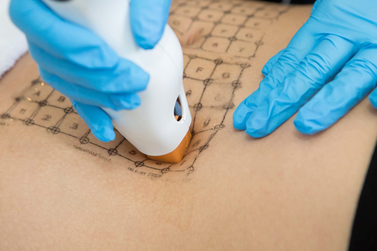 Browse Our Thermage Reviews | Before & After | Skin To Love