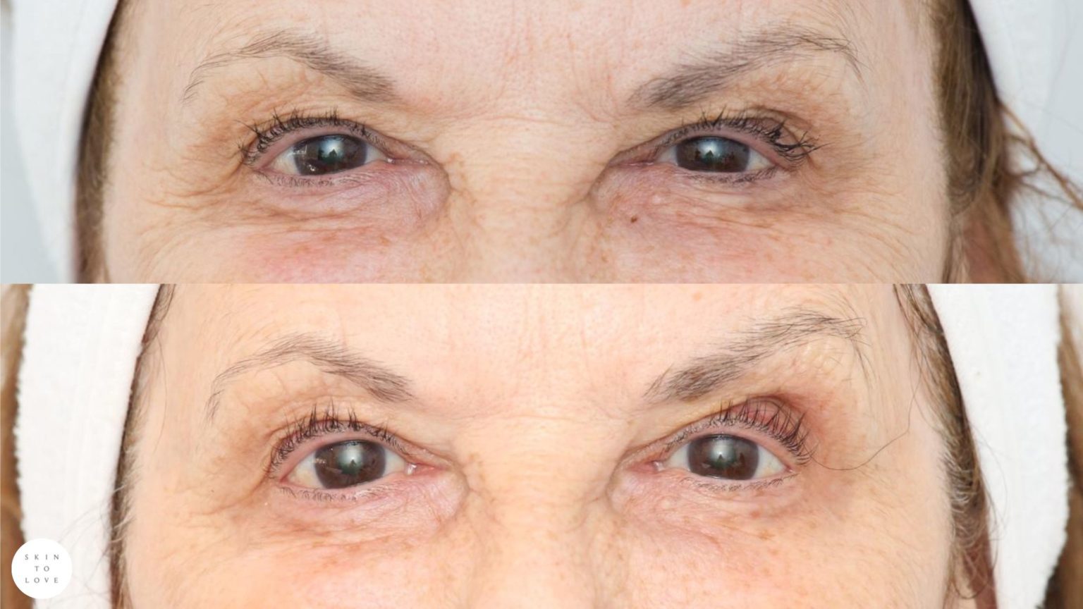 No-Needle Mesotherapy: Is There Such A Thing? | Skin To Love