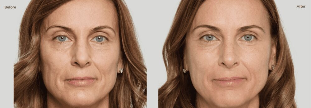Sculptra Treatment | Non-Surgical Face-lift | Benefits & Side Effects