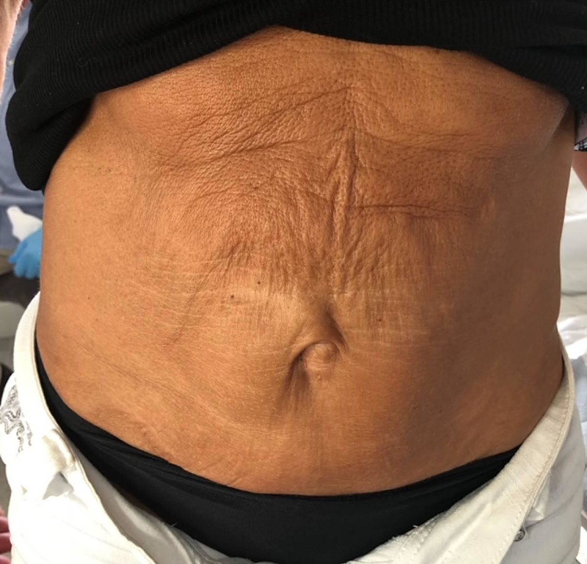 3 Skin Tightening Solutions | The Skin To Love Clinic