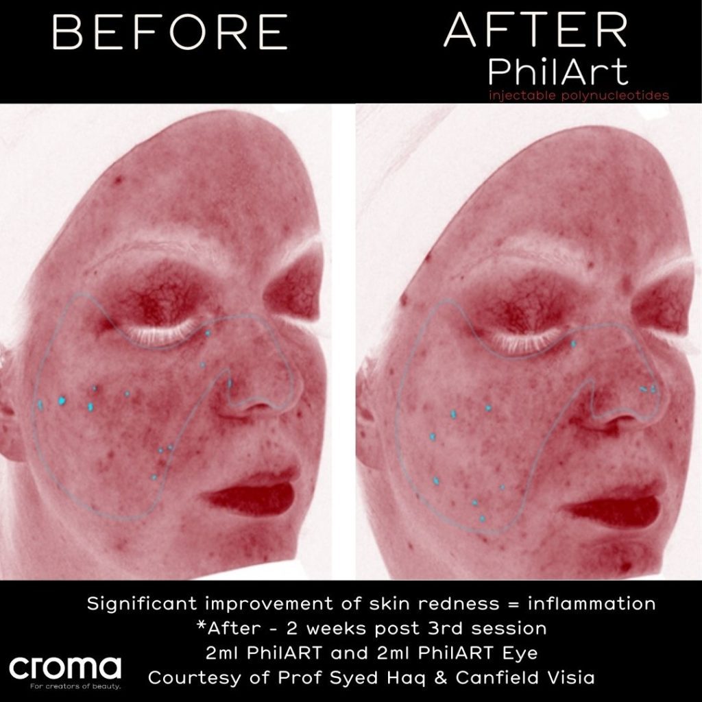 Philart Polynucleotides Treatment | Benefits & Side Effects | S2L