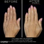 Philart Polynucleotides Treatment | Benefits & Side Effects | S2L