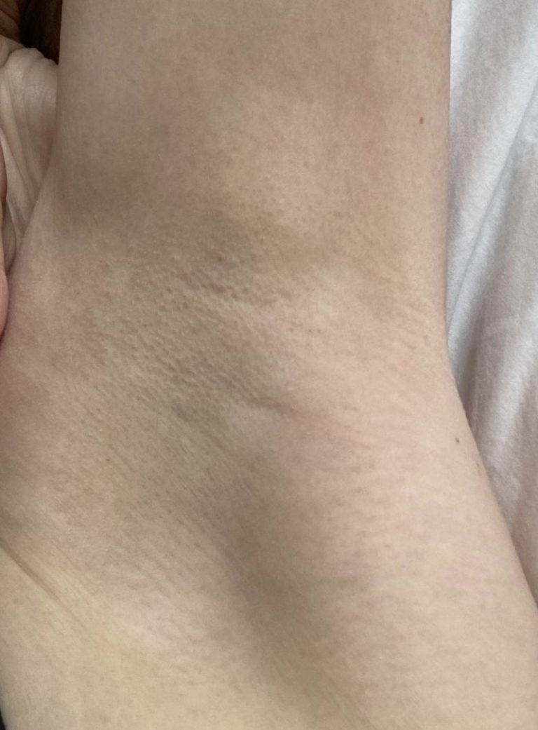 Underarm Laser Hair Removal Before and After-Is It Worth It? | S2L
