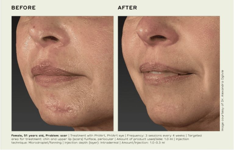 Polynucleotides Treatment: 6 Things To Know Before Trying | S2L