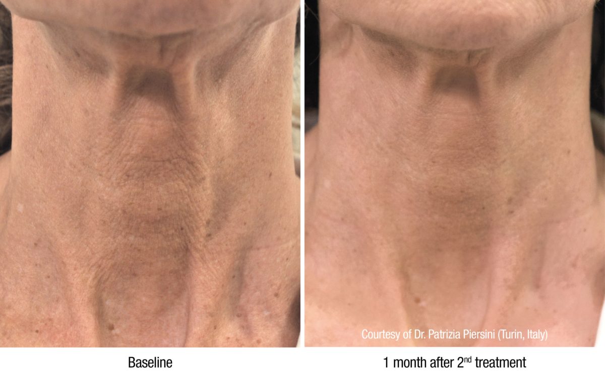 Profhilo Treatment | Before & After Photos | Skin To Love Clinic