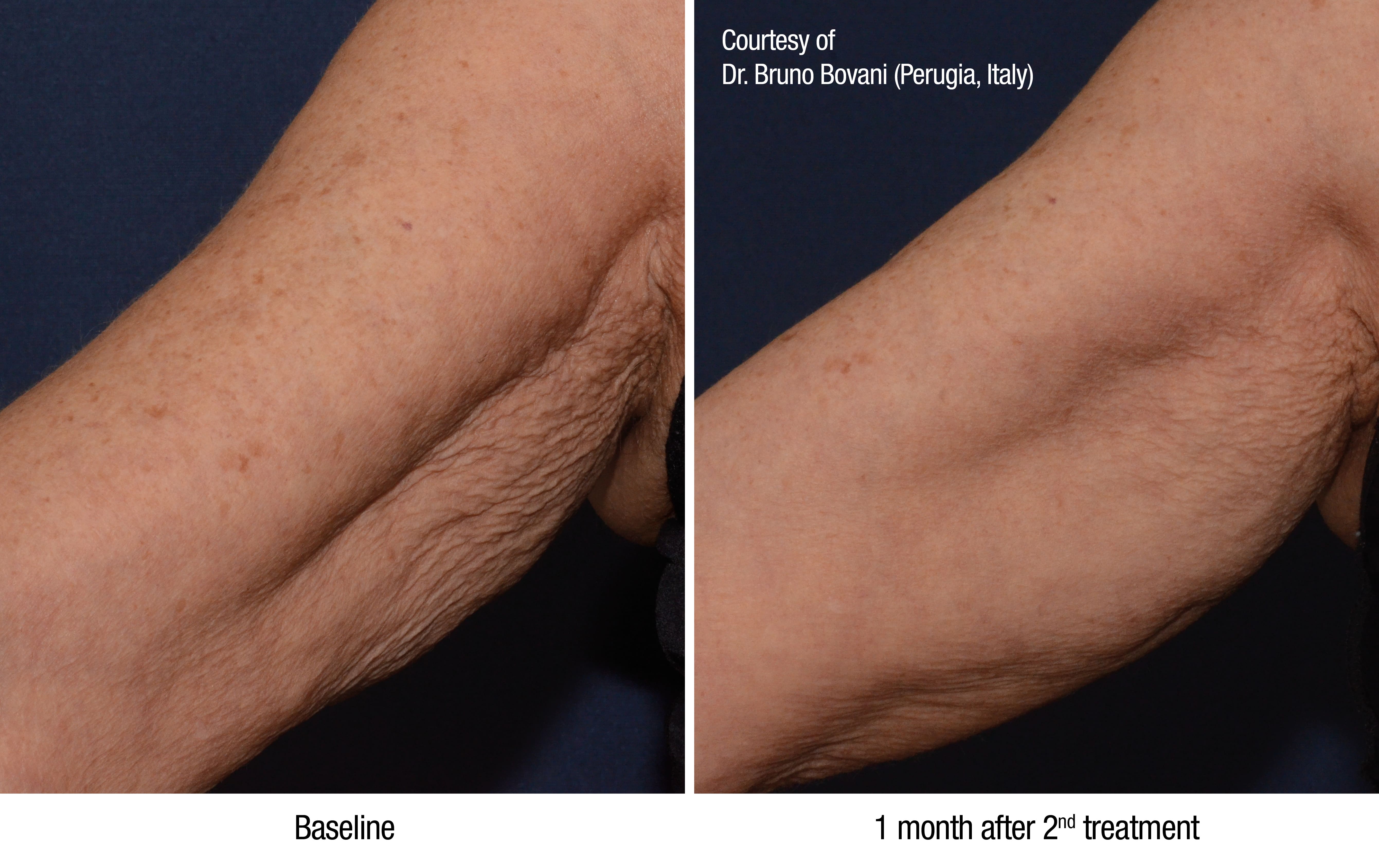 Profhilo Treatment | Before & After Photos | Skin To Love Clinic
