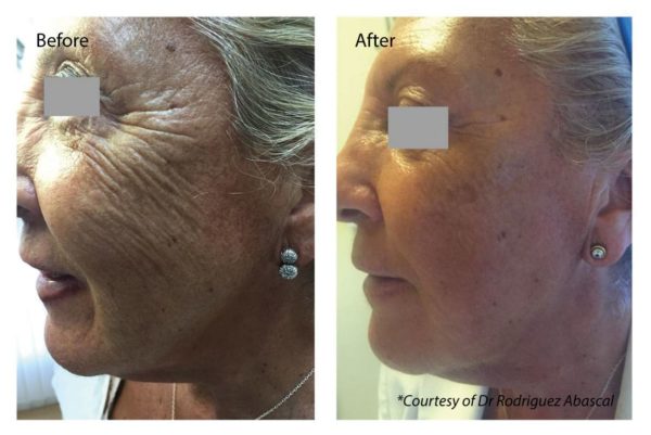 Profhilo Treatment | Before & After Photos | Skin To Love Clinic