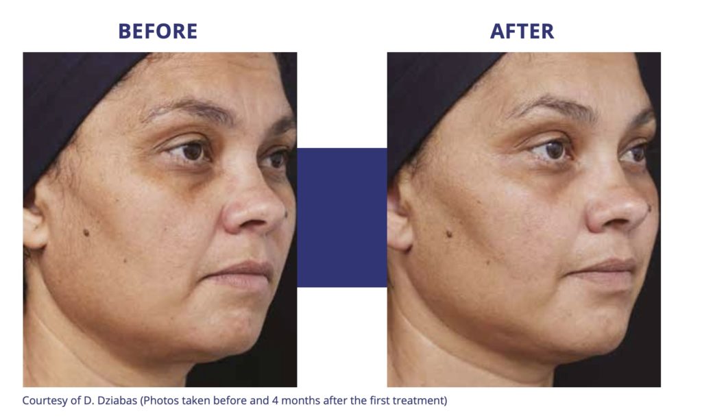Profhilo Structura Treatment | Before & After Photos | Skin To Love