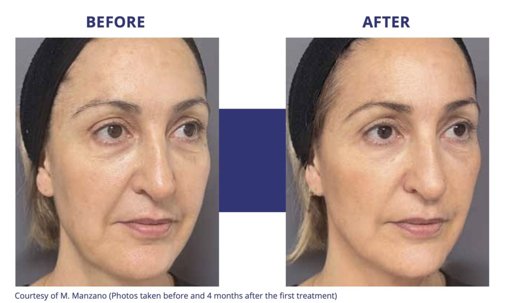 Profhilo Structura Treatment | Before & After Photos | Skin To Love