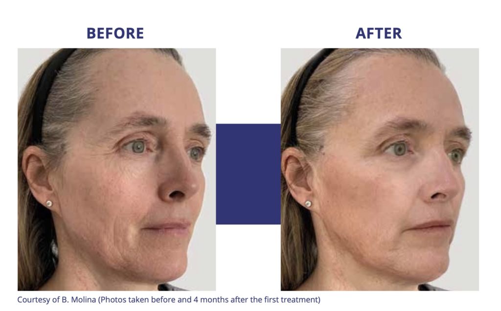 Profhilo Structura Treatment | Before & After Photos | Skin To Love