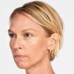 Radisse Treatment | Before & After Photos | Skin To Love
