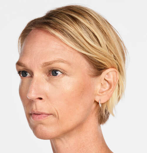 Radisse Treatment | Before & After Photos | Skin To Love