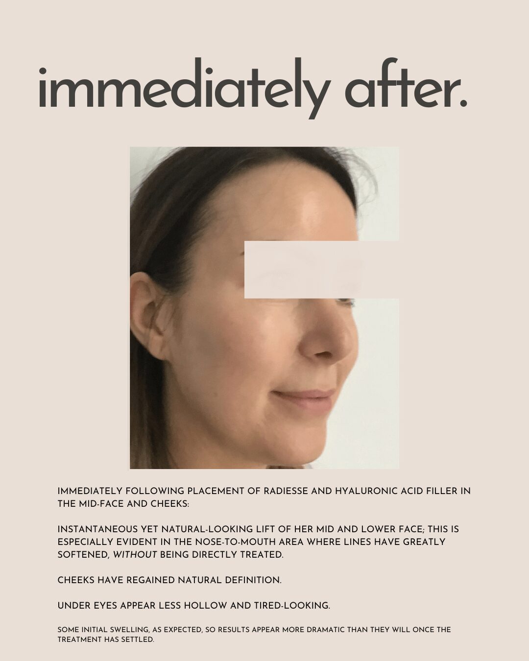 Cheek Filler & Radiesse Near Me, Before and After Photos: Subtle ...